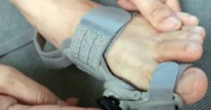 Treatmedy Bunion Fix Reviews From My Personal Experience